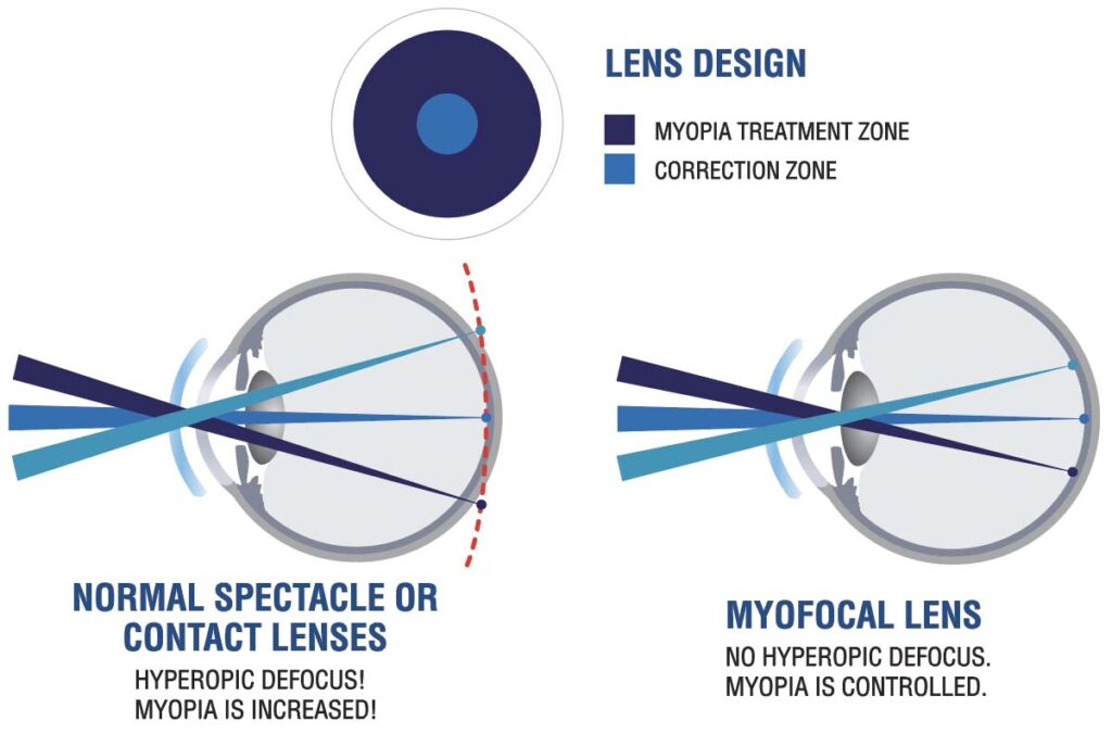 Myopia Control Lenses – Myofocal - Ocuviq GP